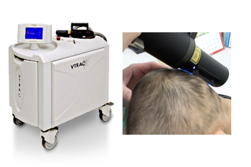 えぬくりブログ: 円形脱毛症のエキシマ紫外線療法